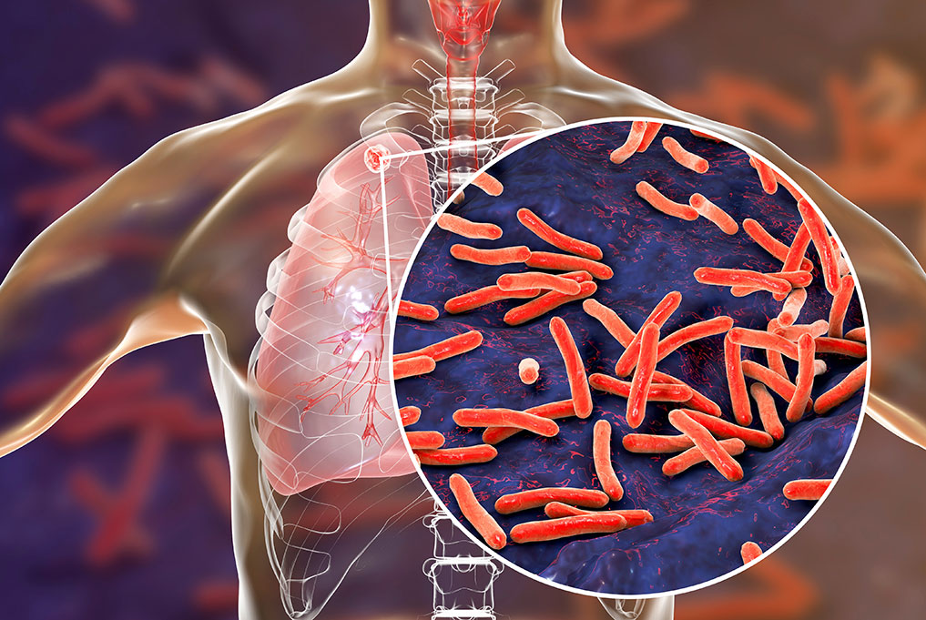 La tuberculose | Agence régionale de santé Normandie